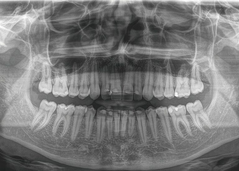 Panaromic X-Ray – Dentaristo